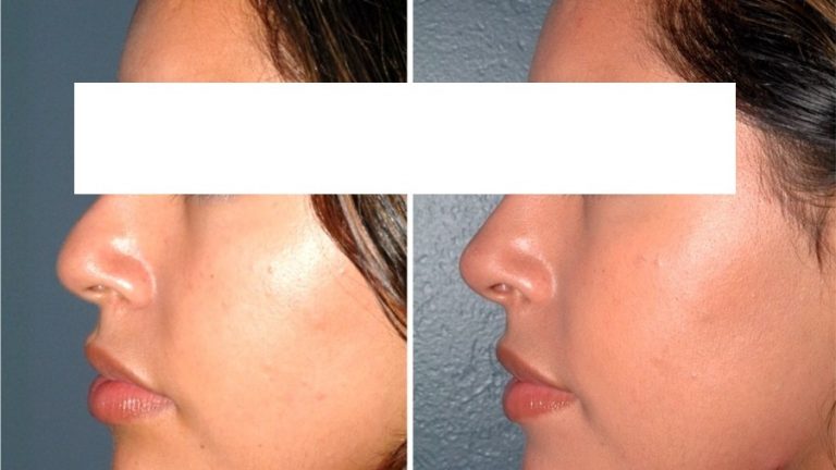 Podizanje vrha nosa botoksom – brzo rešenje za mladalački izgled - Estetic