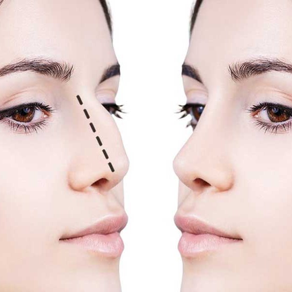 Korekcijom nosa do privlačnijeg izgleda - Estetic