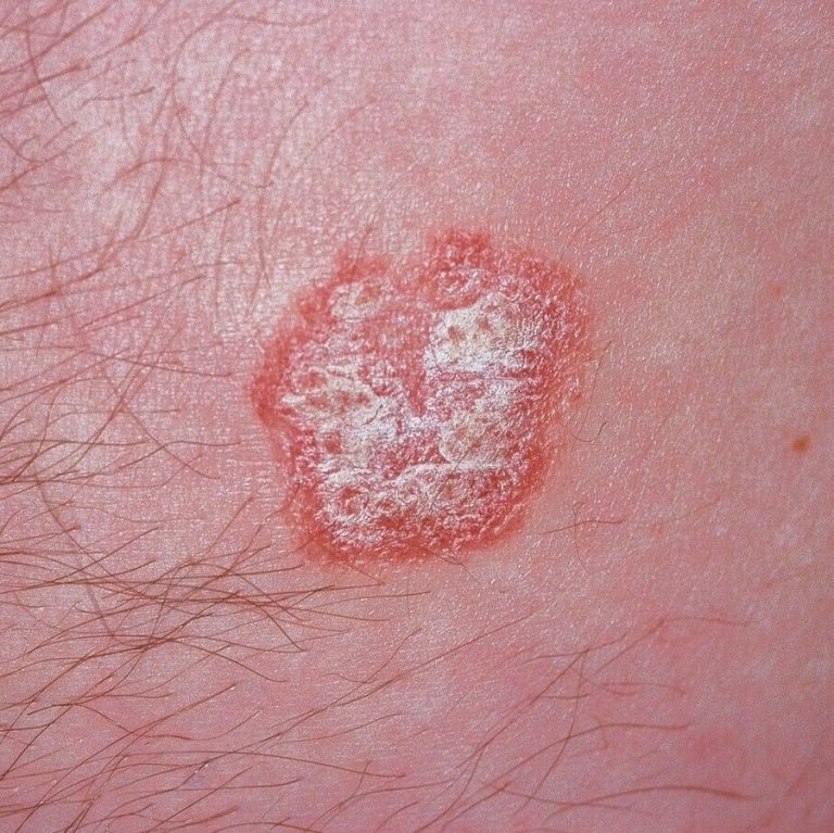 Psorijaza: uzroci i lečenje - Estetic