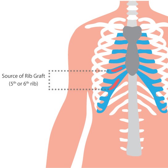 3D bioprintingom stvorili nosnu hrskavicu - Estetic